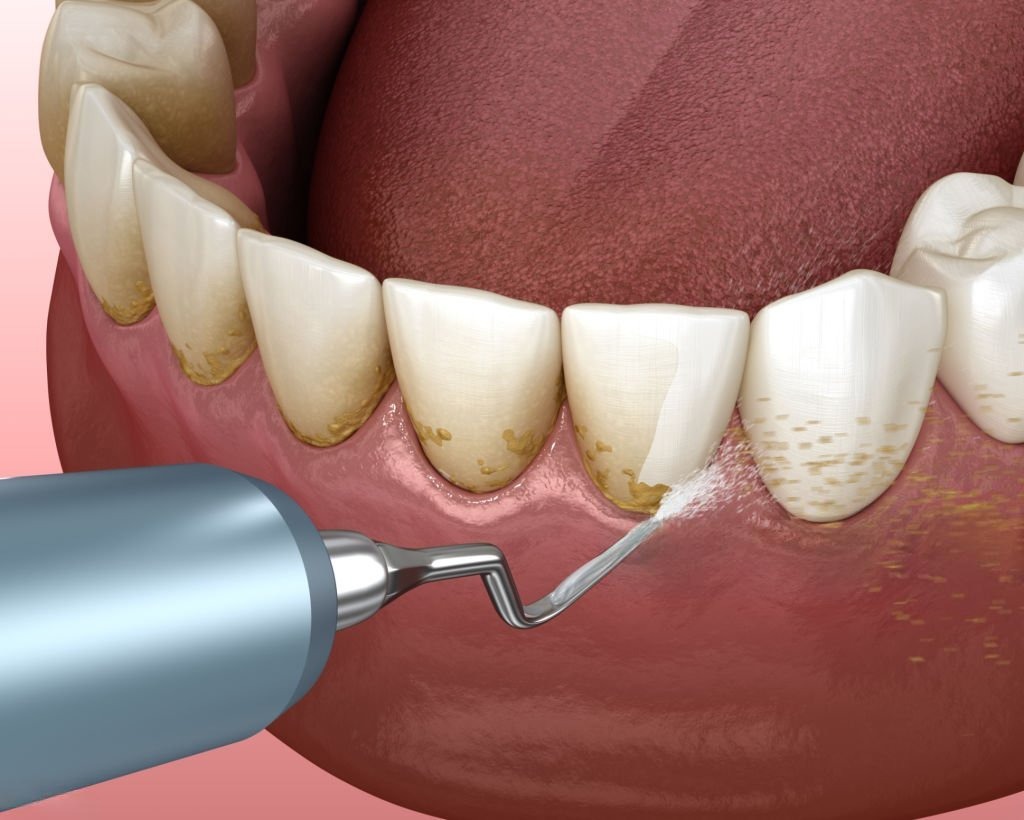 Periodontal Disease Treatment - The Perio Centre | Edmonton ...
