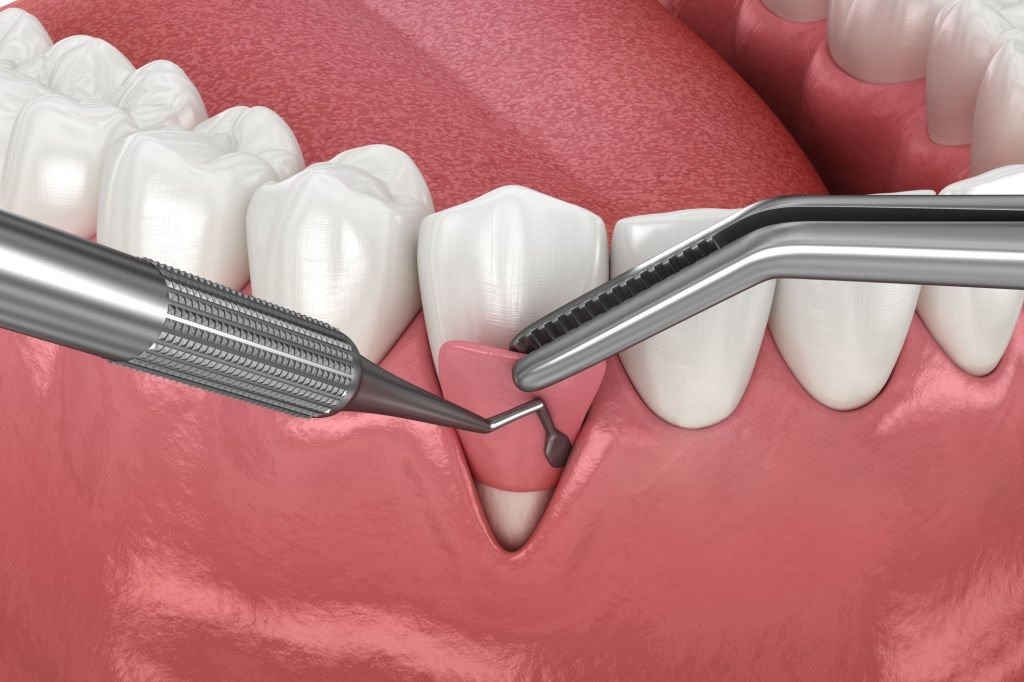 Gum Recession Treatment - The Perio Centre | Edmonton Periodontist ...